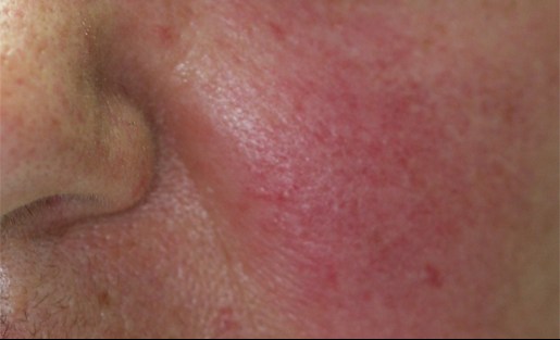 Taches brunes et traitement au laser