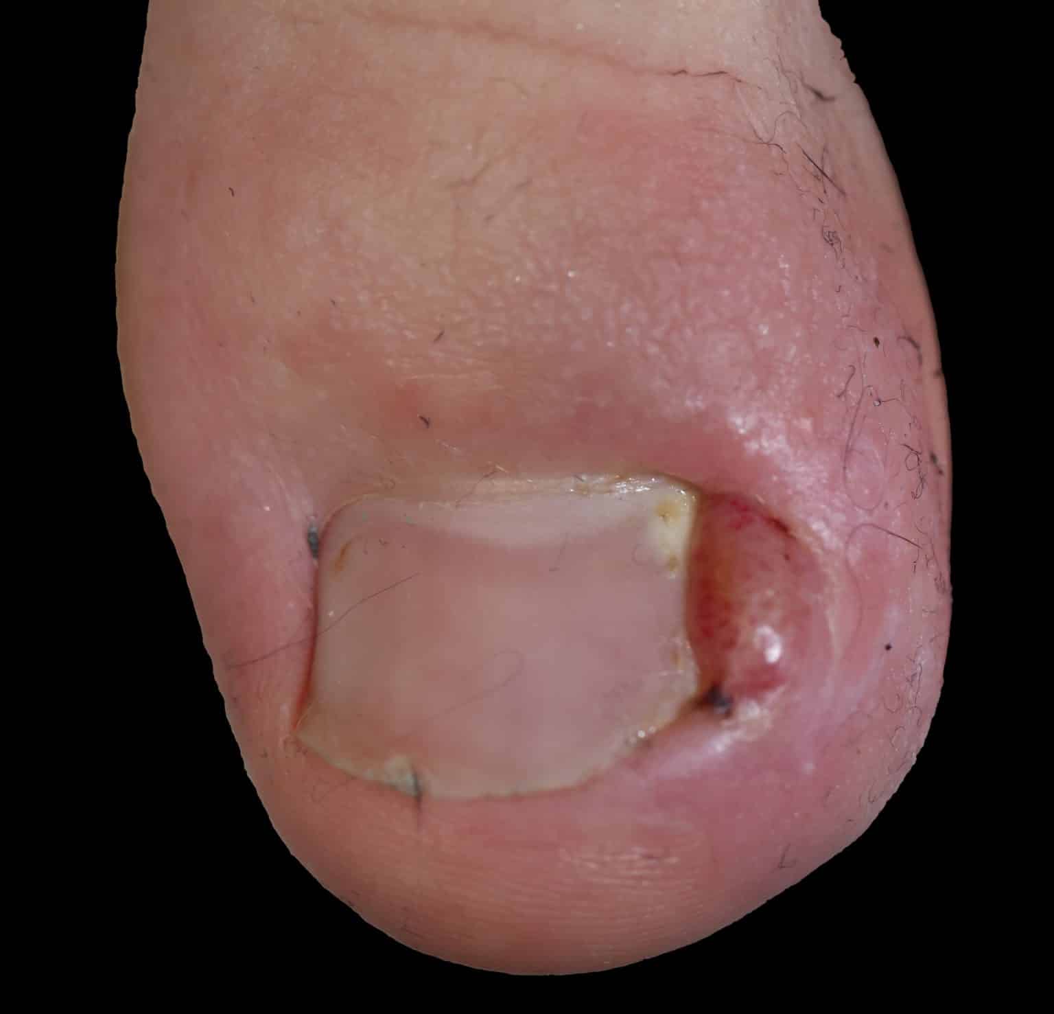 Ongle incarné : Causes, Symptômes, Traitements - Dr. Philippe Abimelec ...